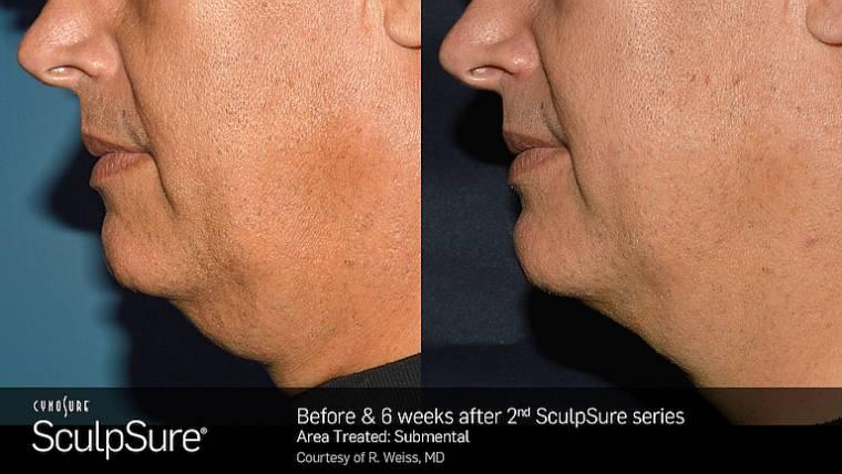 SculpSure in Toronto / For Men And Women! - Ontario Men's Health